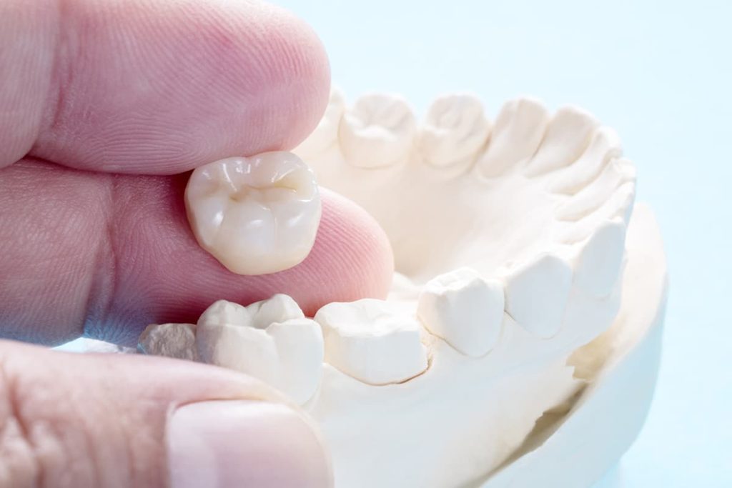 How Much Tooth Structure Is Needed For A Crown?